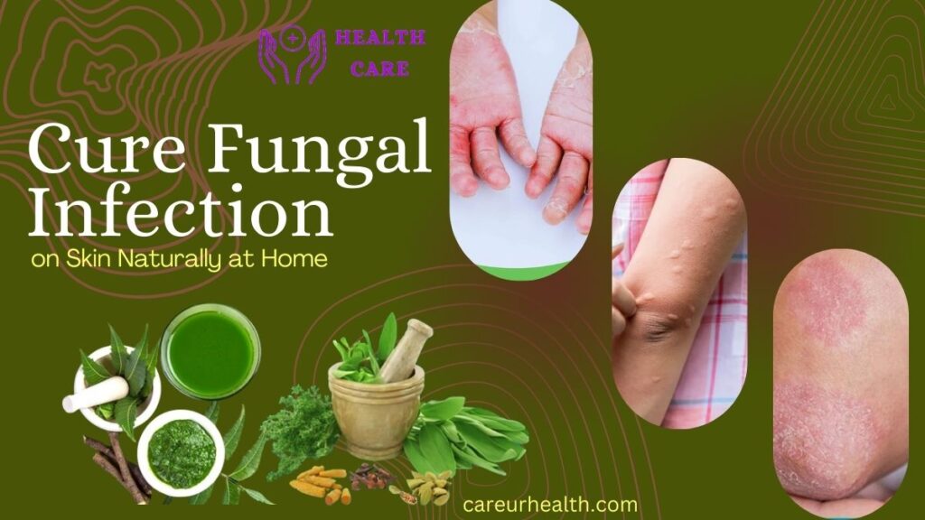 how to cure fungal infection on skin naturally at home